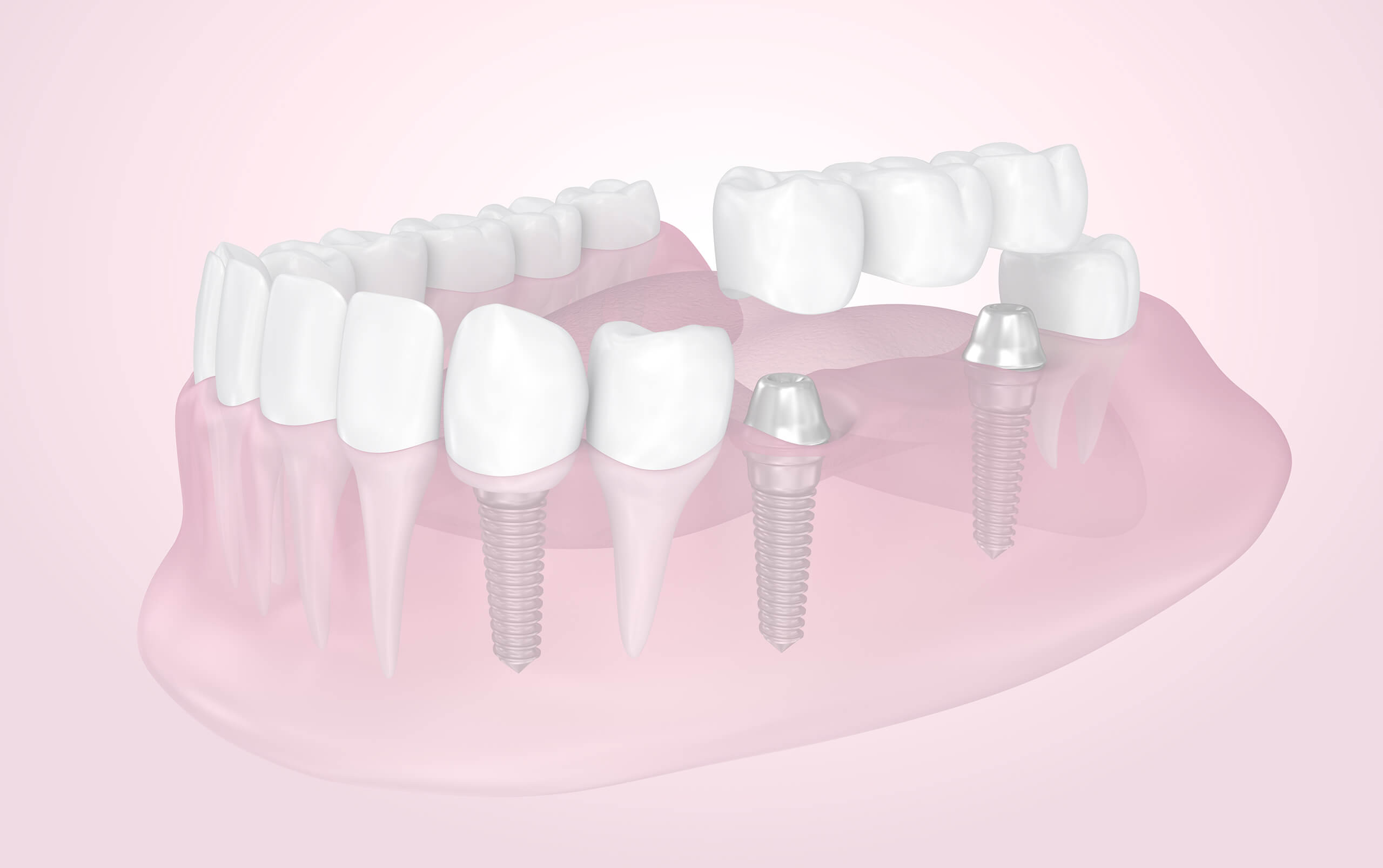 Etapes d’un traitement implantaire - Dentiste Saint-Doulchard